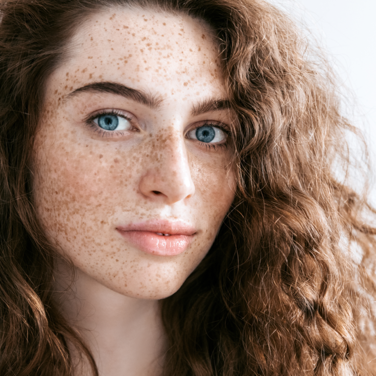 Manchas / Melasma - Samira Bonomo